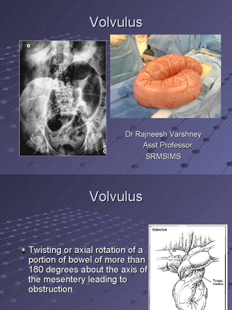 Volvulus Neonatorum