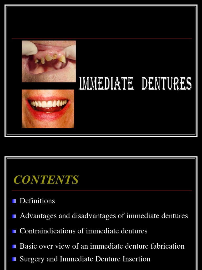 Immediate Dentures Steps