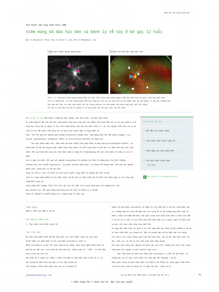 Bilateral Panuveitis and Myeloradiculopathy in A 12 Year Old Girl | PDF