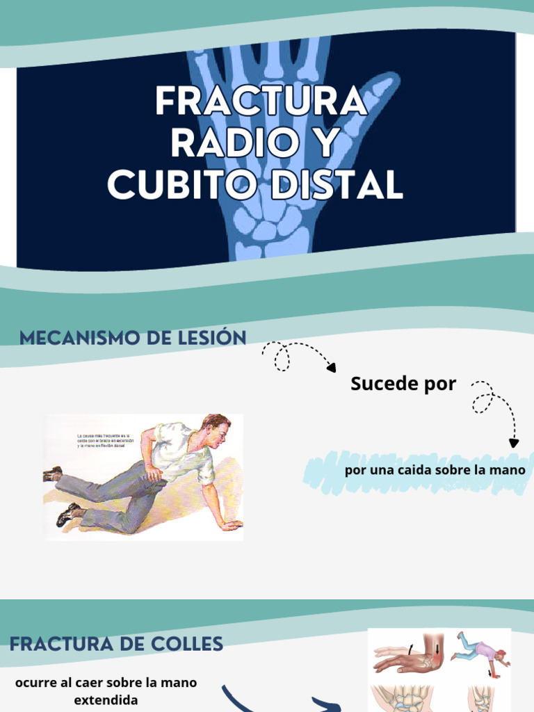 Presentación Fx Radio-cubital | PDF