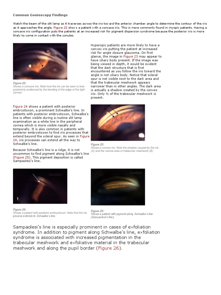 Common Gonioscopy Findings | PDF | Glaucoma | Visual System