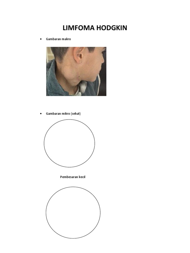 Laporan PA Limfoma Hodgkin Dan Non Hodgkin | PDF