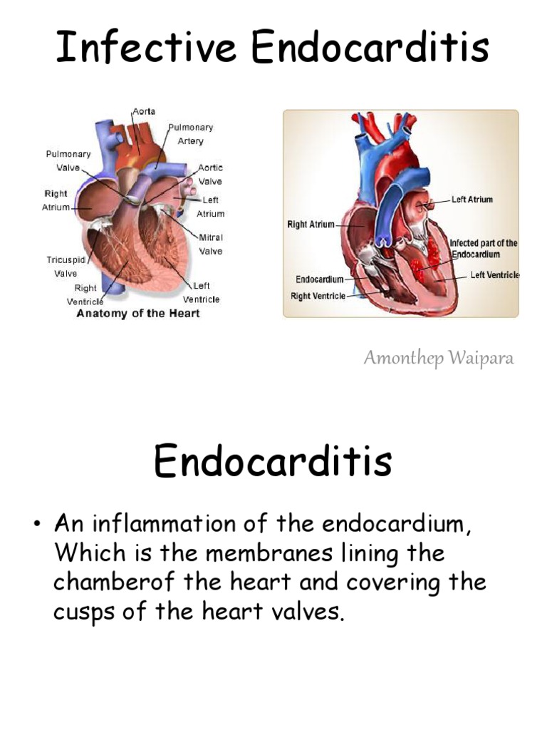 Infective Endocarditis Overview and Treatment | PDF | Streptococcus ...