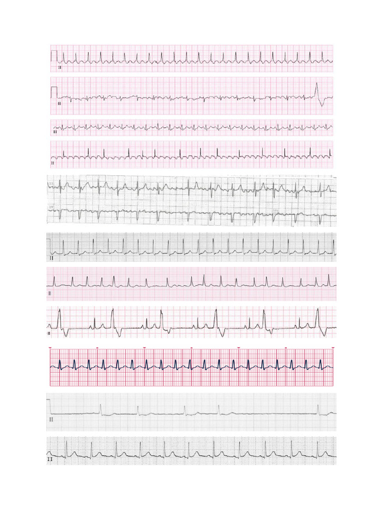 Afib and Aflutter Rhythm Strips | PDF