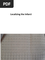 Understanding Wellens Syndrome ECG Patterns | PDF | Electrocardiography ...