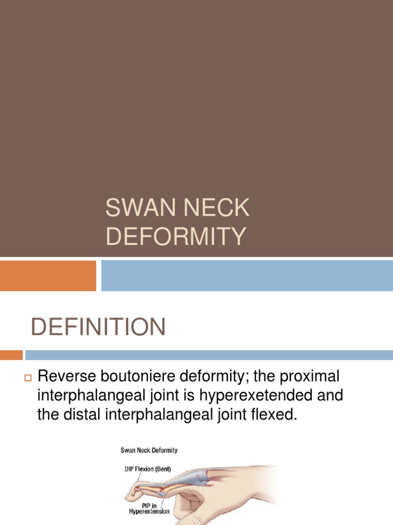 Swan Neck Deformity | Finger | Anatomical Terms Of Motion