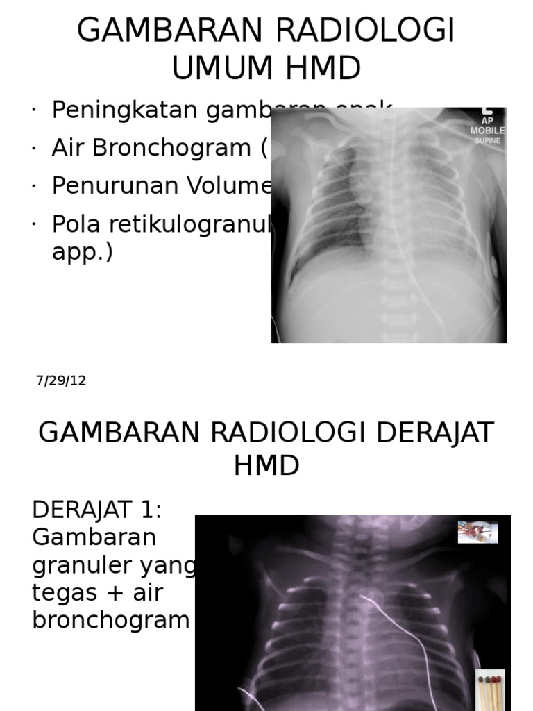 Gambaran Radiologi Umum HMD | PDF