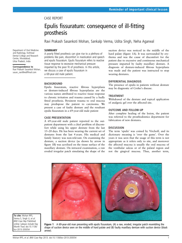 Epulis Fissuratum Consequence of Ill-Fitting | PDF | Dentures | Medicine