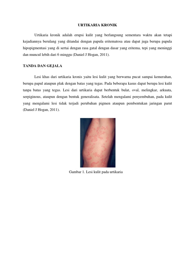 Urtikaria Kronik Mita | PDF