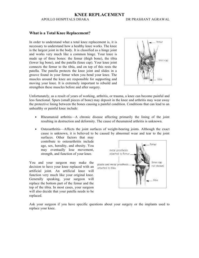 What Is A Total Knee Replacement SINGLE PAGE | PDF | Wellness