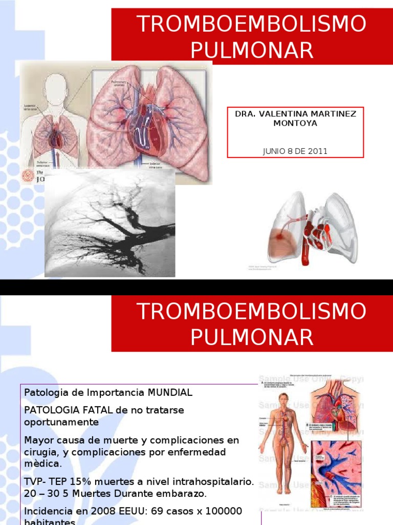 Tromboembolismo Pulmonar | Medicina CLINICA | Especialidades Medicas