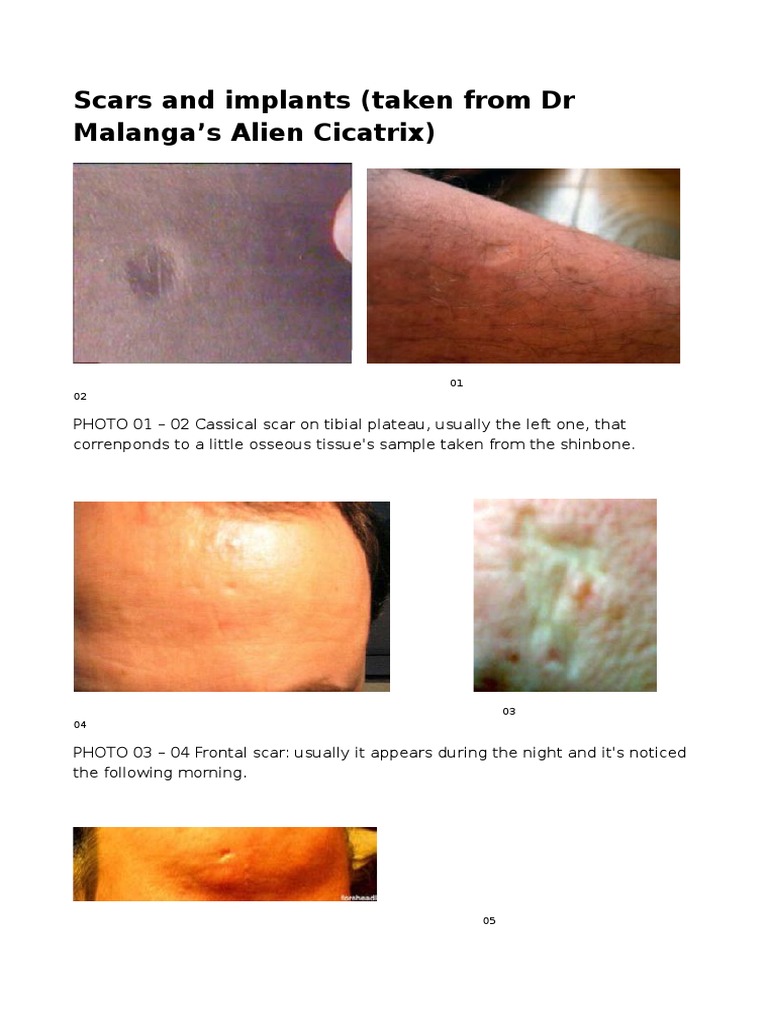 Alien Abduction Scars and Implants | PDF