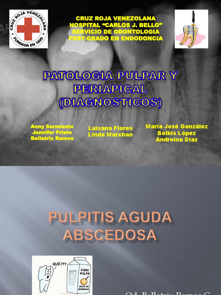 Pulpitis Aguda Abscedosa | PDF