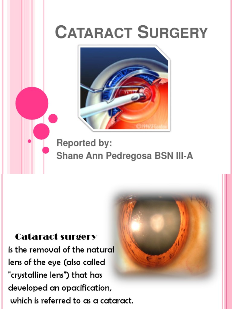 Cataract Surgery | PDF | Cataract | Glaucoma