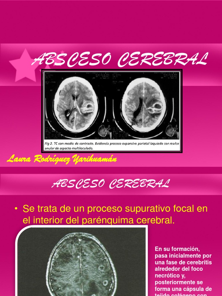 Absceso Cerebral | Inmunología | Enfermedades y trastornos