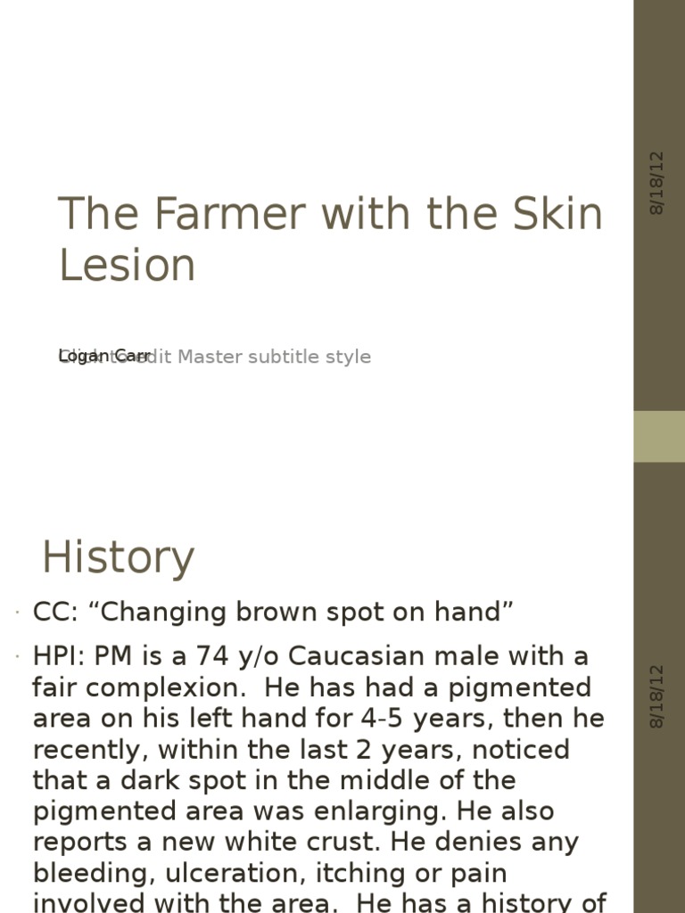 Malignant Melanoma Pdf Melanoma Cutaneous Conditions