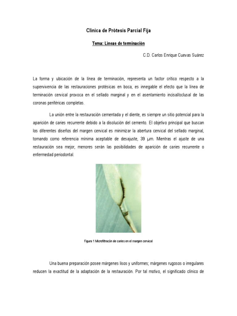 Líneas de Terminación - Clínica de Prótesis Parcial Fija | PDF ...