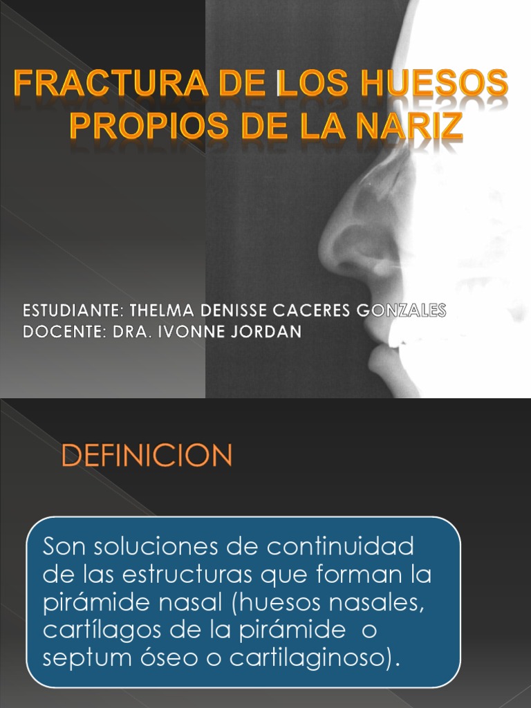Fractura de Los Huesos Propios de La Nariz | PDF | Hueso | Lesión