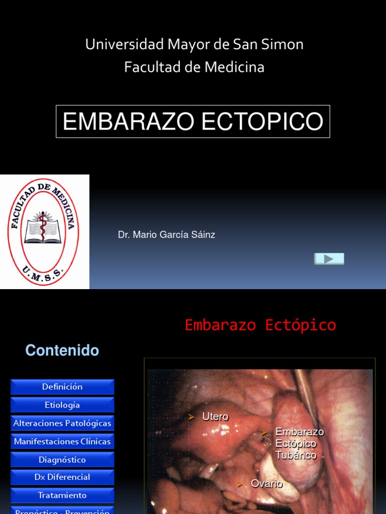 Embarazo EctÓpico Clase El Embarazo Diagnostico Medico
