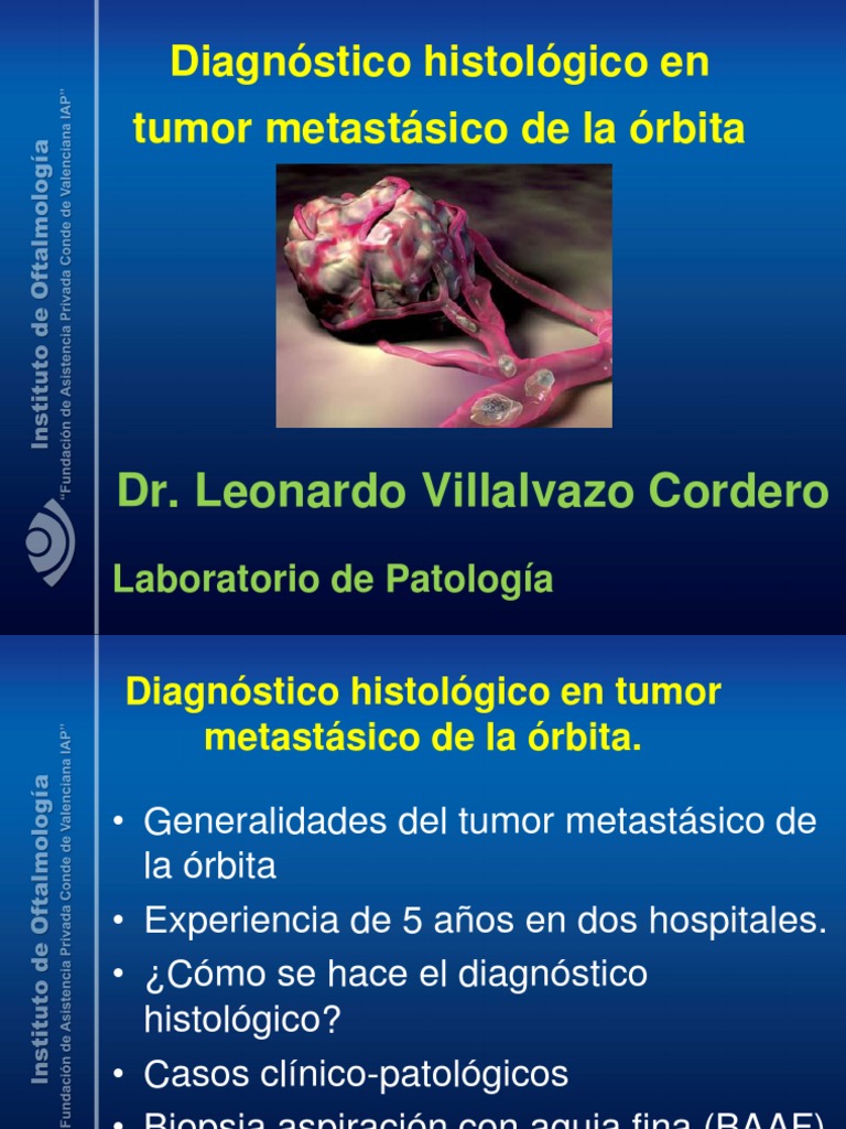 Diagnostico Histologico de Tumor Metastasico de Orbita | PDF | Metástasis | Sarcoma