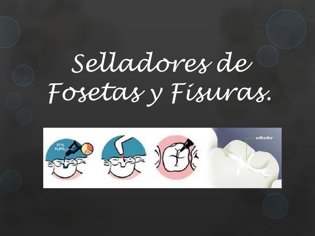 Selladores de Fosetas y Fisuras | PDF | Odontología | Bienestar