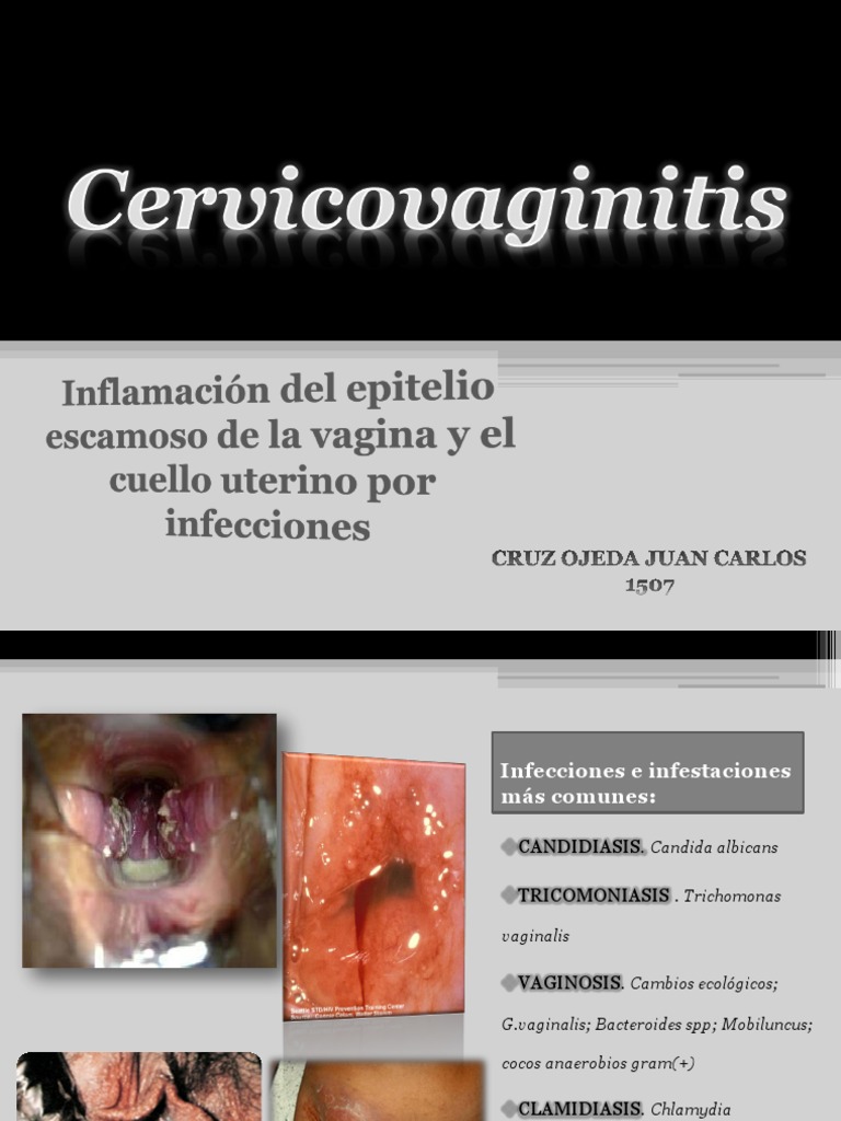 Infecciones Genitales Frecuentes en La Mujer (Vaginosis | PDF ...