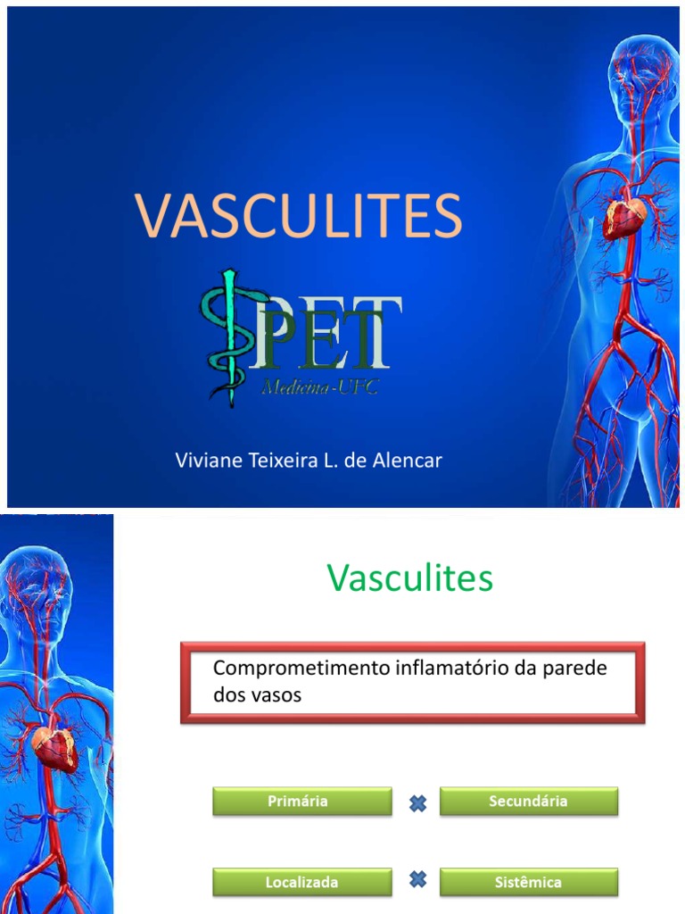 Compreendendo as Vasculites: Classificação, Fisiopatologia e ...