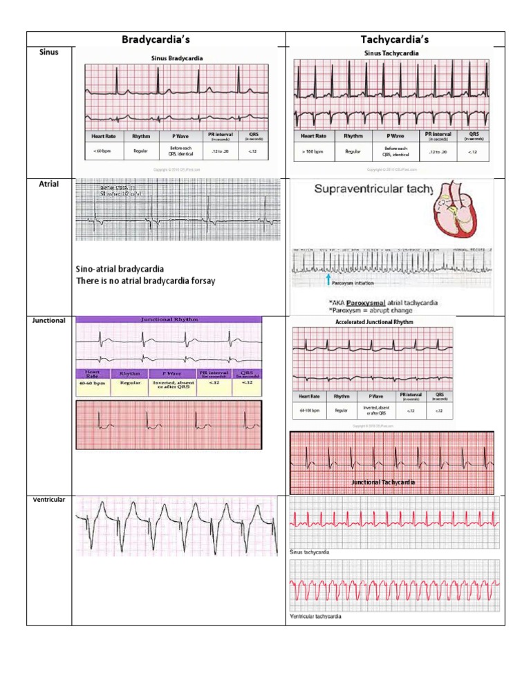 450 Cardiac Rhythm Strips My Chart 1 | PDF