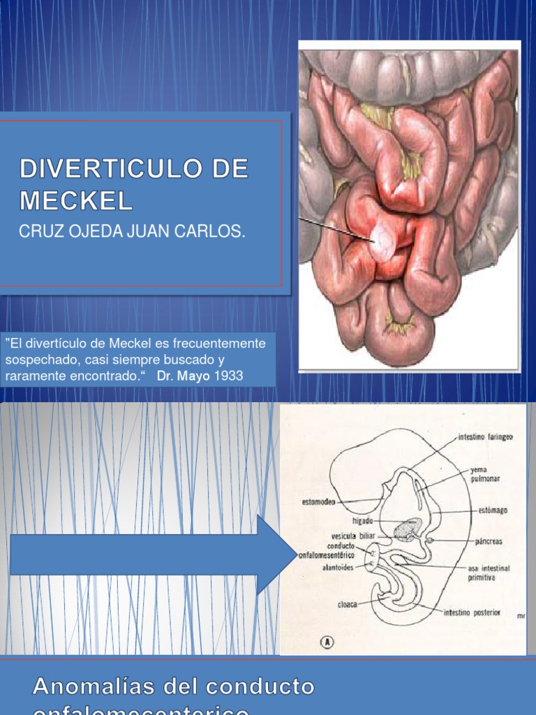 Diverticulo de Meckel | Rtt | Enfermedades digestivas