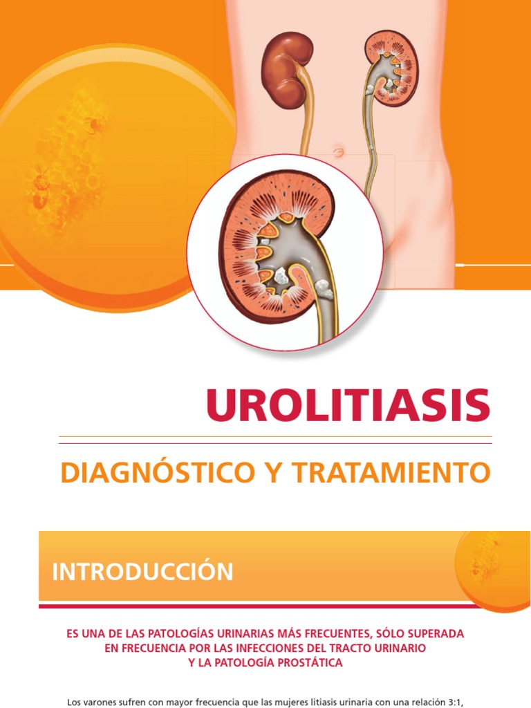 Urolitiasis: Diagnóstico y tratamiento | Enfermedades y trastornos ...