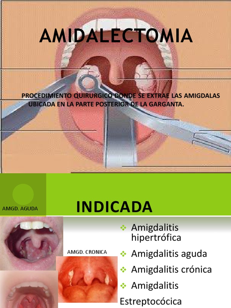 Amigdalectomia1 110518220240 Phpapp02 | PDF | Lengua | Cirugía