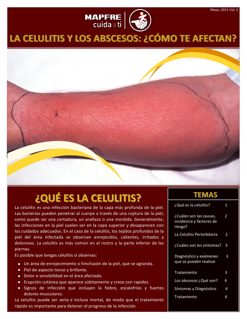 Celulitis y Absceso | Especialidades médicas | Medicina clínica