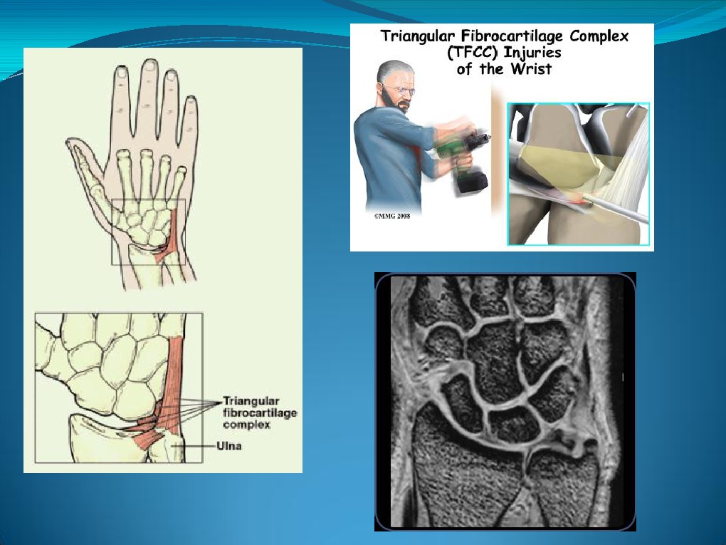 TFCC | PDF | Musculoskeletal System | Limbs (Anatomy)