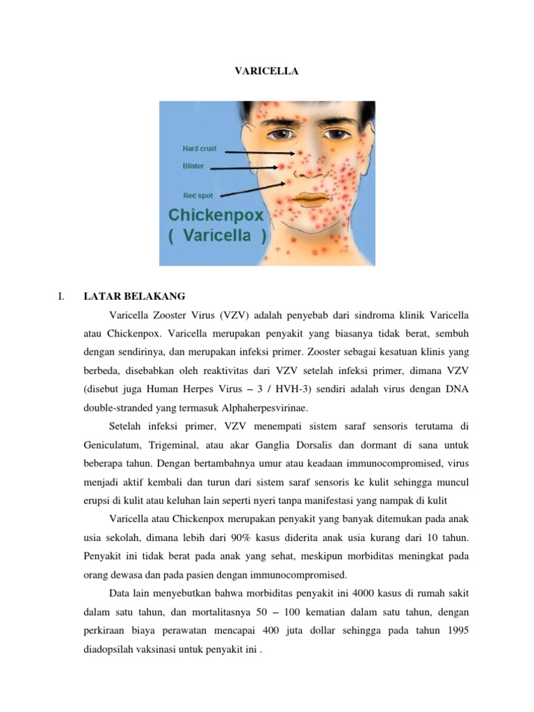Varicella | PDF