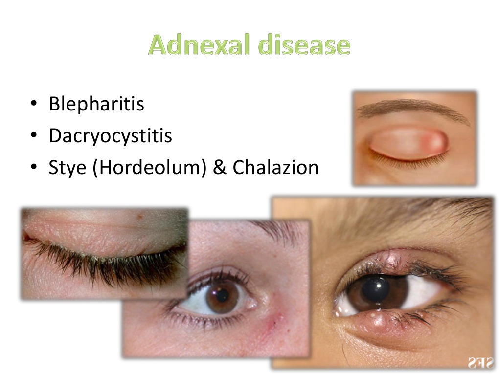 Adnexal Diseases, Corneal Abrasion, FB | PDF | Ophthalmology | Diseases Of The Eye And Adnexa