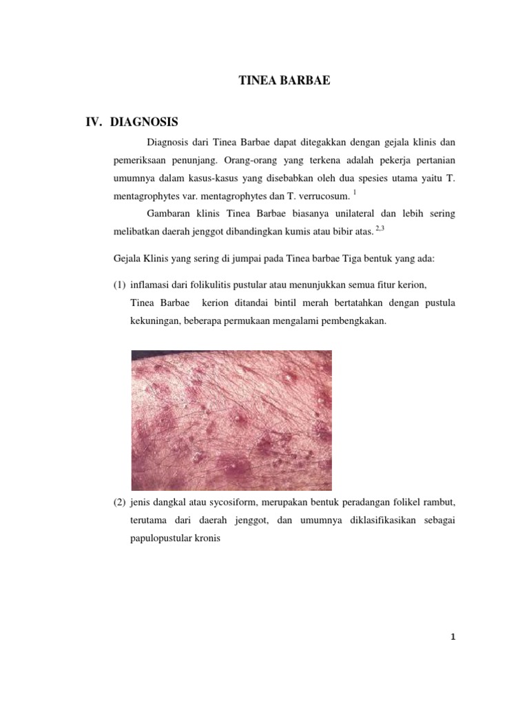 Tinea Barbae | PDF