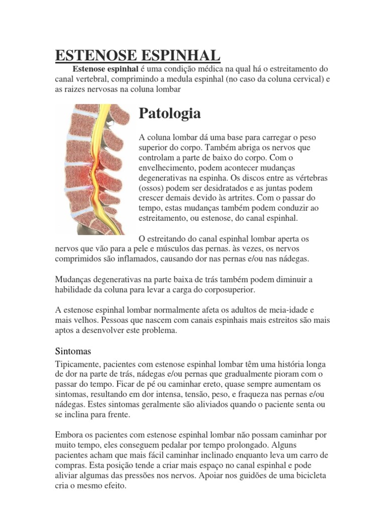 Estenose Espinhal: Causas, Sintomas E Exercícios Recomendados – MVFG