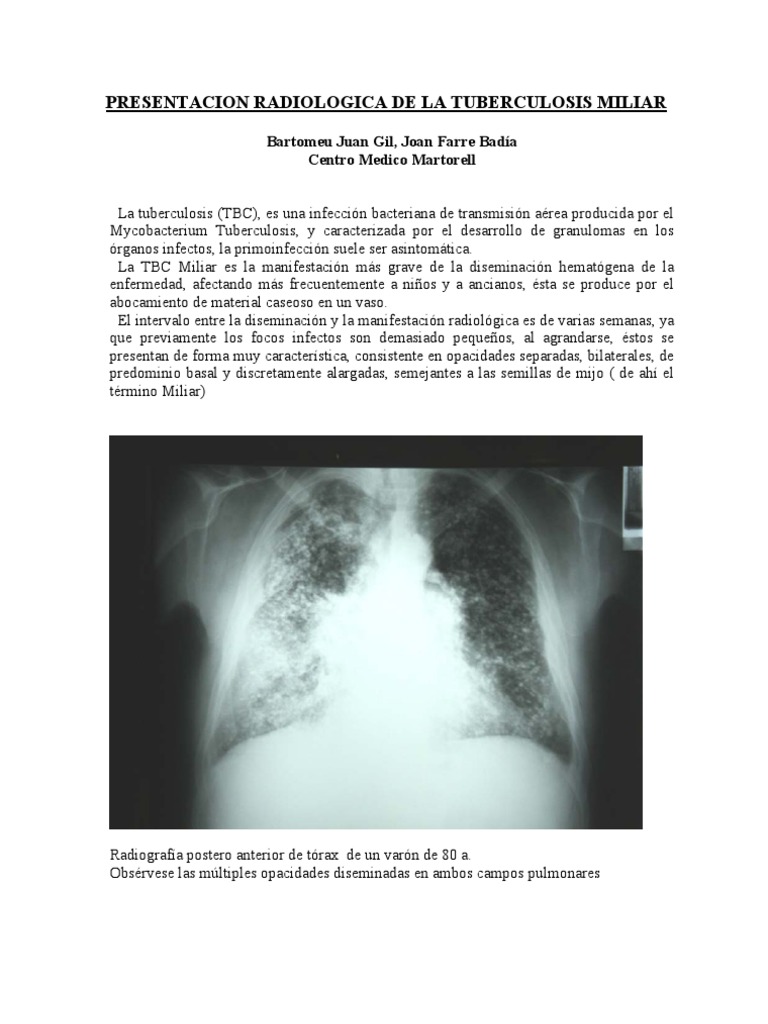 Presentacion Radiologica de La Tuberculosis Miliar | PDF