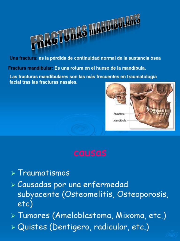 Fracturas Mandibulares: Causas y Tratamientos | PDF | Especialidades ...