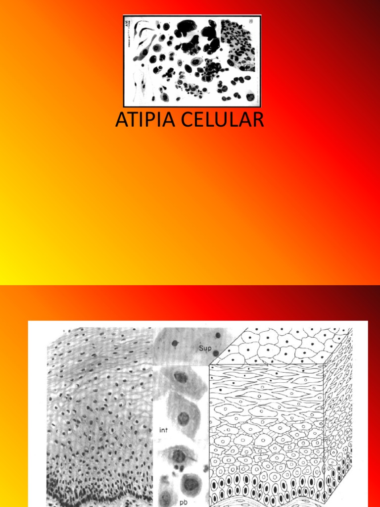 Atipia Celular Exposicion | PDF | Epitelio | Biología Celular)