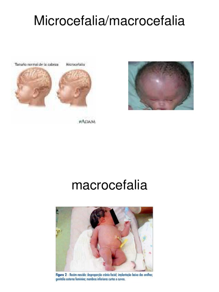 Microcefalia | PDF