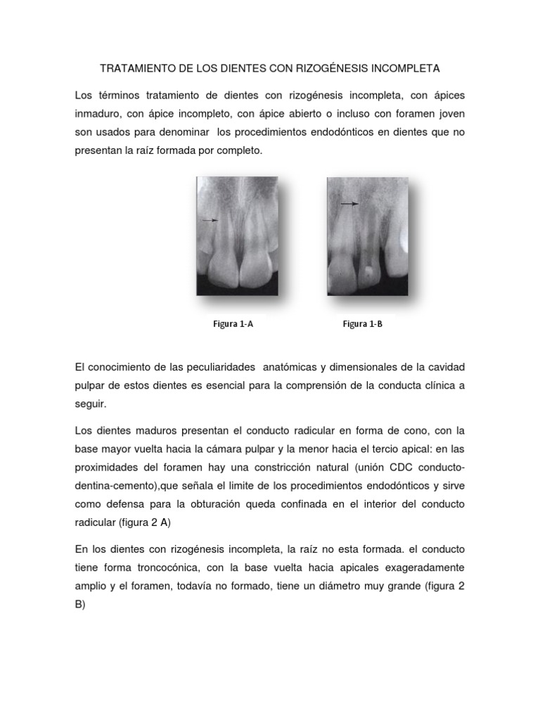 Tratamiento de Rizogénesis Incompleta | PDF | Diente humano ...
