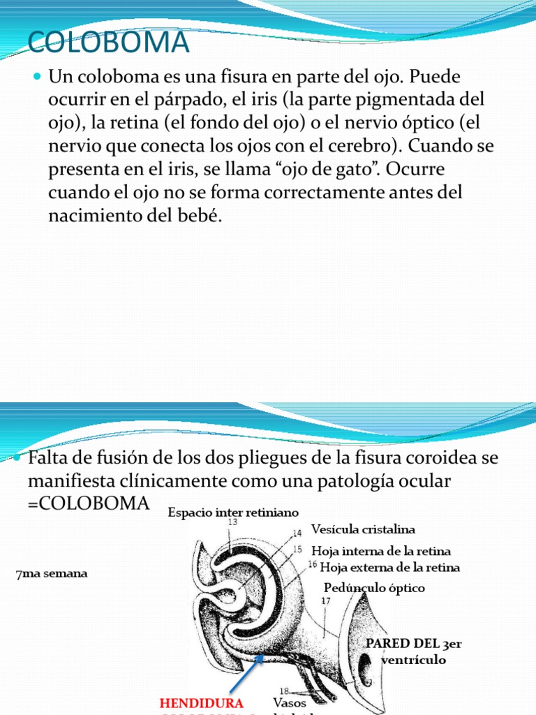 Tipos y tratamiento del coloboma ocular | PDF | Ojo humano | Visión