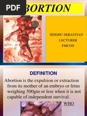 Laminaria Tent For Abortion