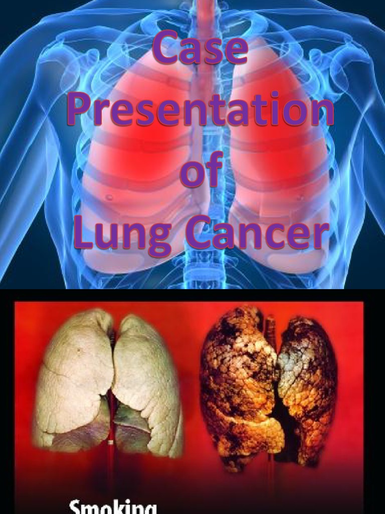 Understanding Lung Cancer: Causes, Symptoms, Staging, Treatment and ...