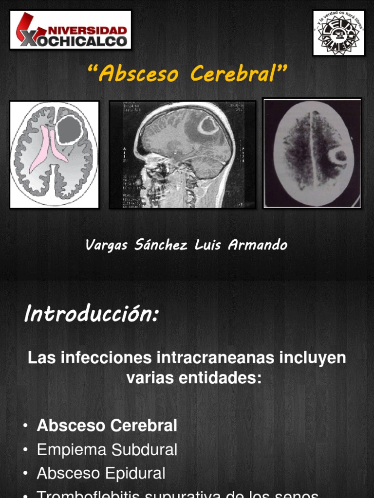 Absceso Cerebral | Enfermedades y trastornos | Especialidades Medicas