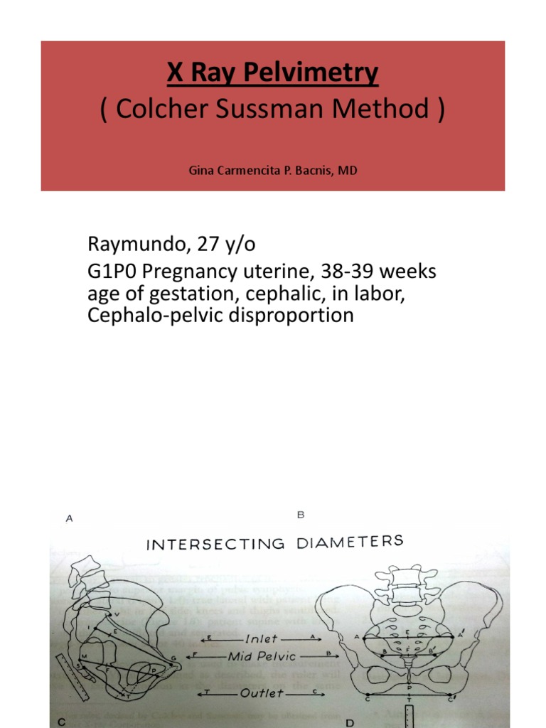 X-Ray Pelvimetry for Cephalopelvic Disproportion | PDF