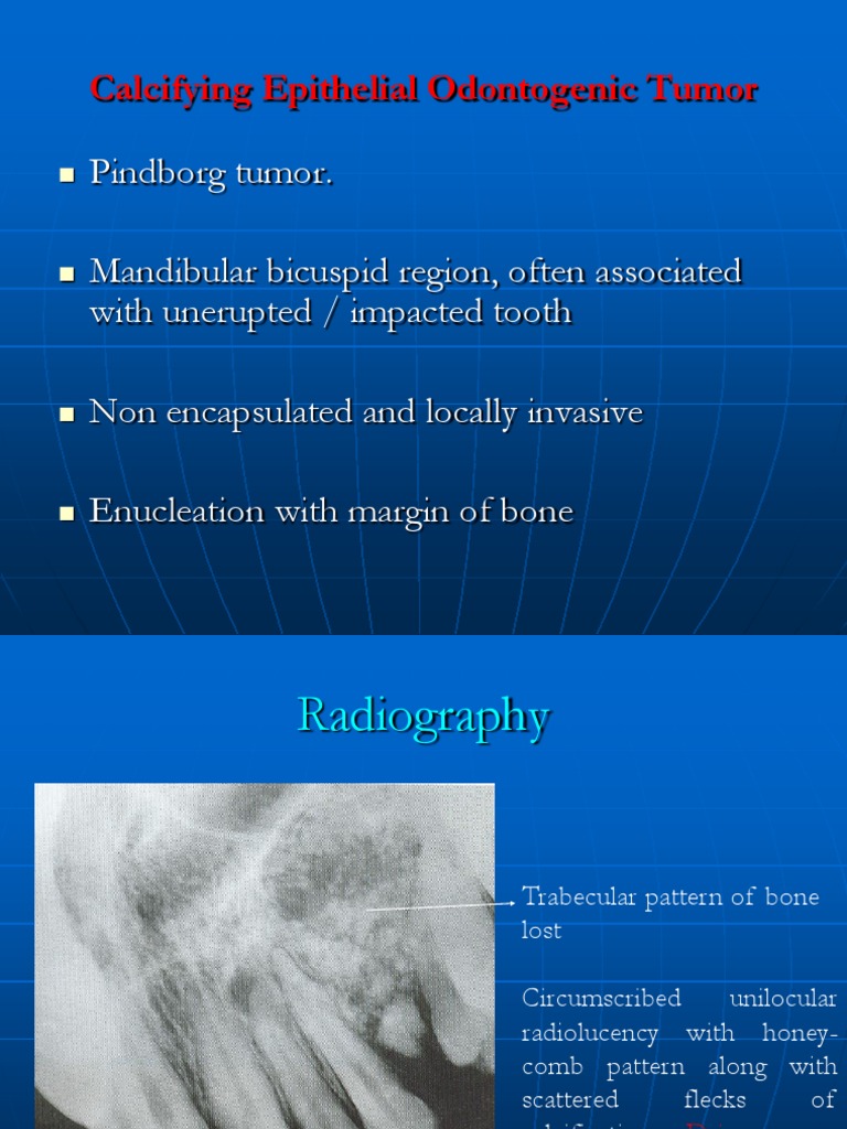 Calcifying Epithelial Odontogenic Tumor Radiography