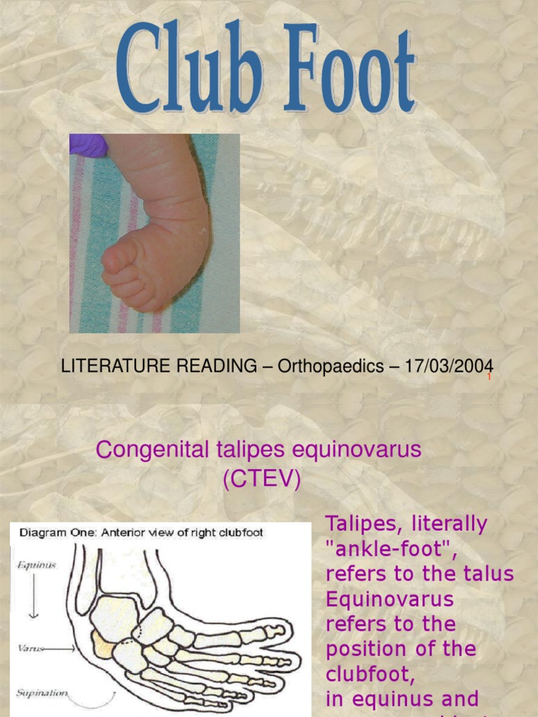 Club Foot Diagram