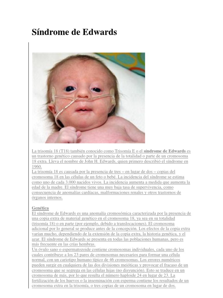 Síndrome de Edwards | PDF | Nucleo celular | Genética